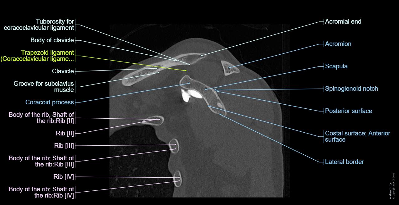 Ct Arthrogram Of The Shoulder Joint Normal Anatomy E Anatomy