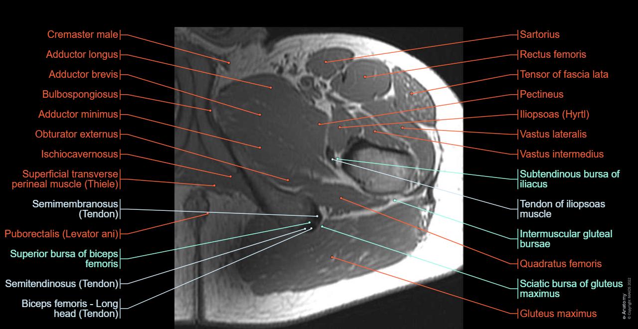 Mri Anatomy Of Hip Joint Hip Avascular Necrosis Osteonecrosis In NYC mri-anatomy-of-hip-joint-hip-avascular-necrosis-osteonecrosis-in-nyc