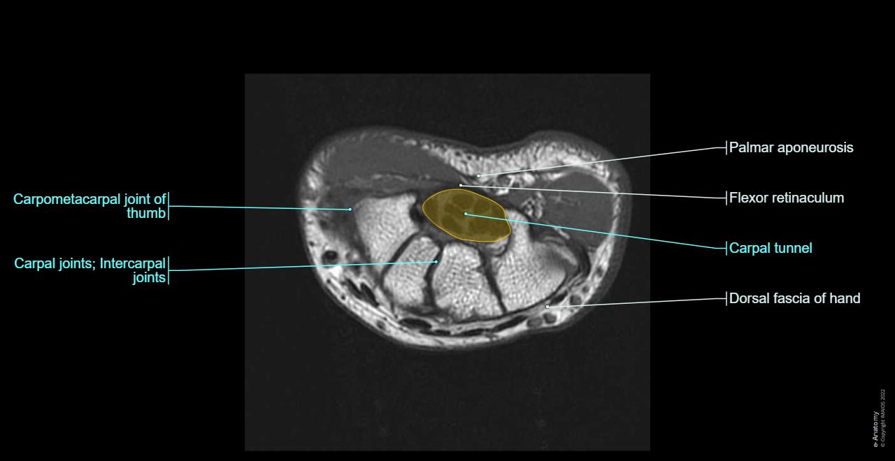 Wrist on 3T MR and 3D pictures: normal anatomy | e-Anatomy Wrist on 3T MR and 3D pictures: normal anatomy | e-Anatomy